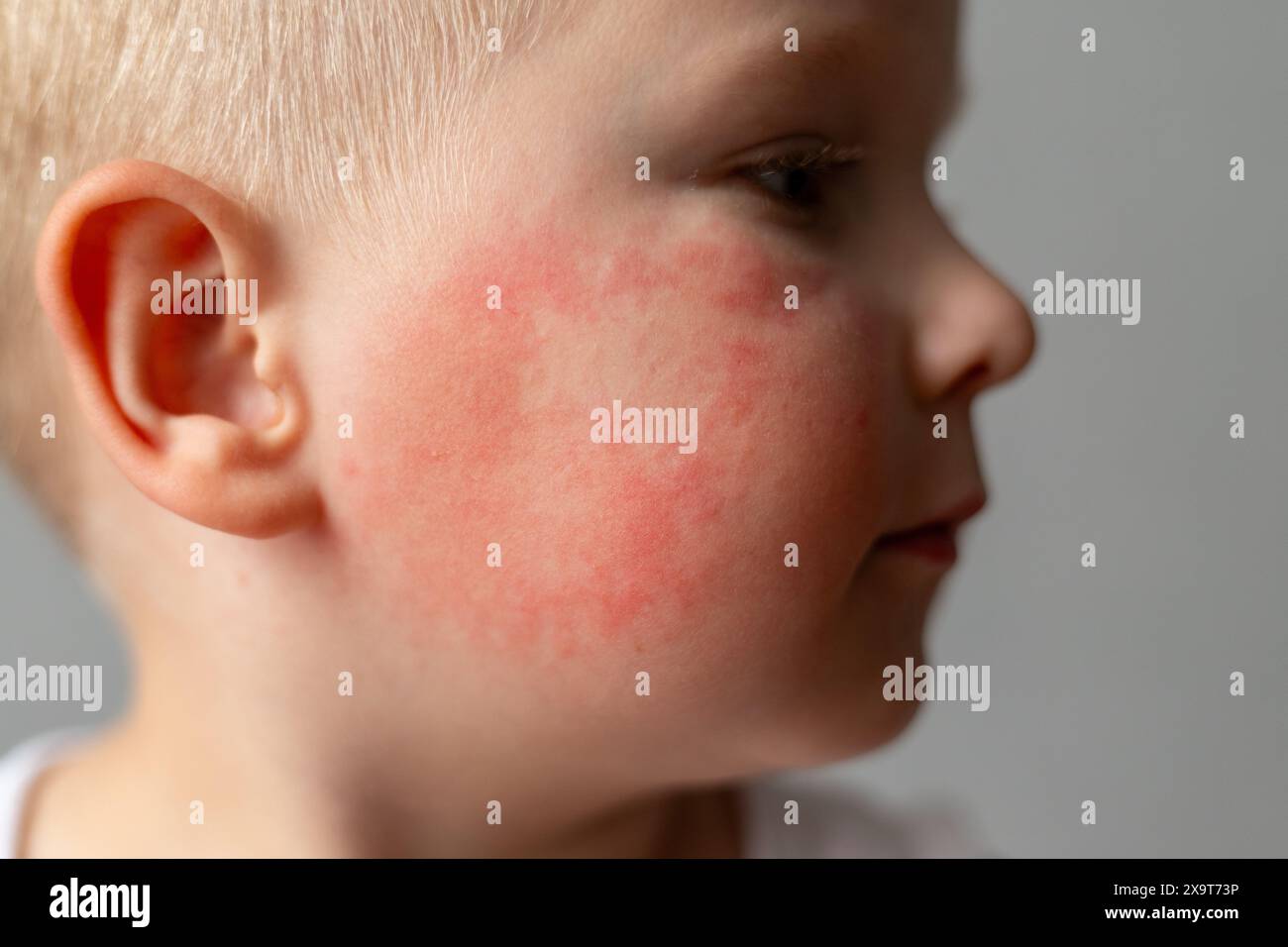 Small child with red rash on cheek Stock Photo - Alamy
