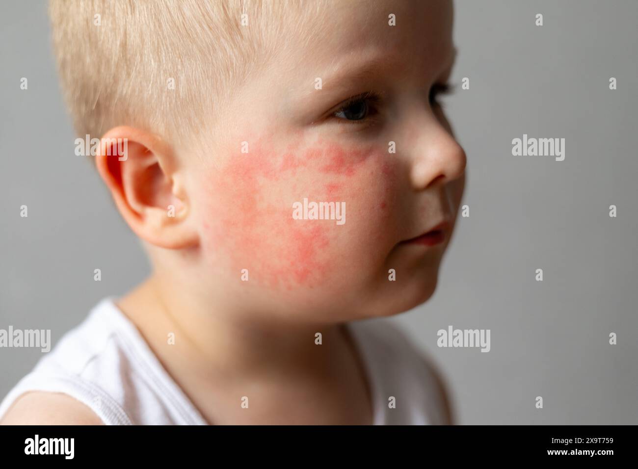 Small child with red rash on cheek Stock Photo - Alamy