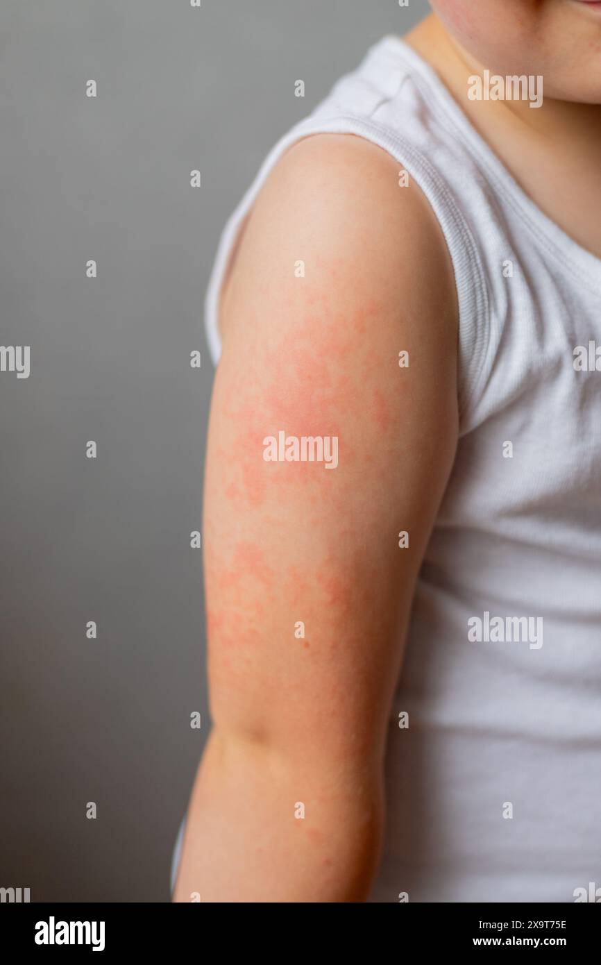 Child's arm with red rash Stock Photo - Alamy