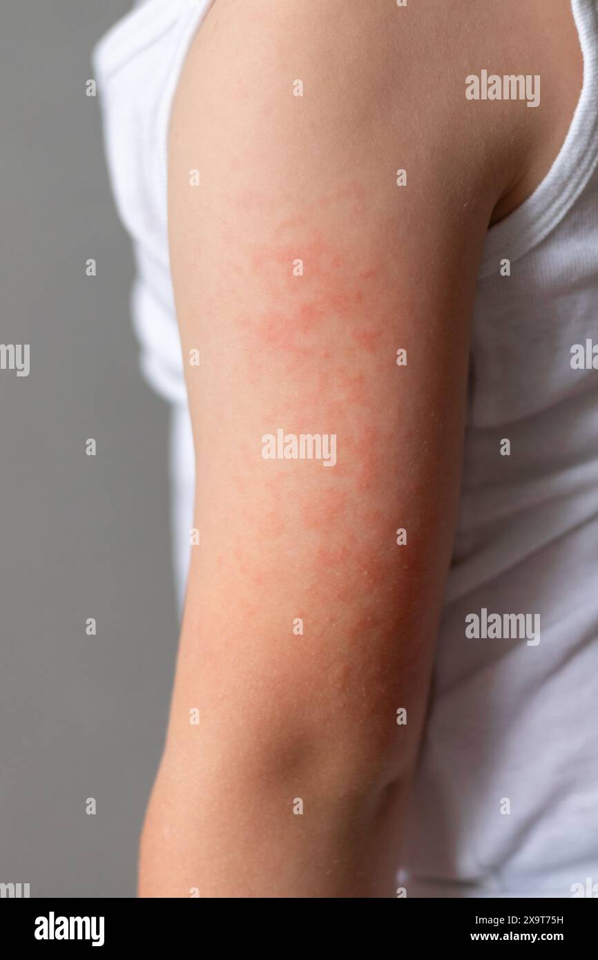 Child's arm with red rash Stock Photo - Alamy