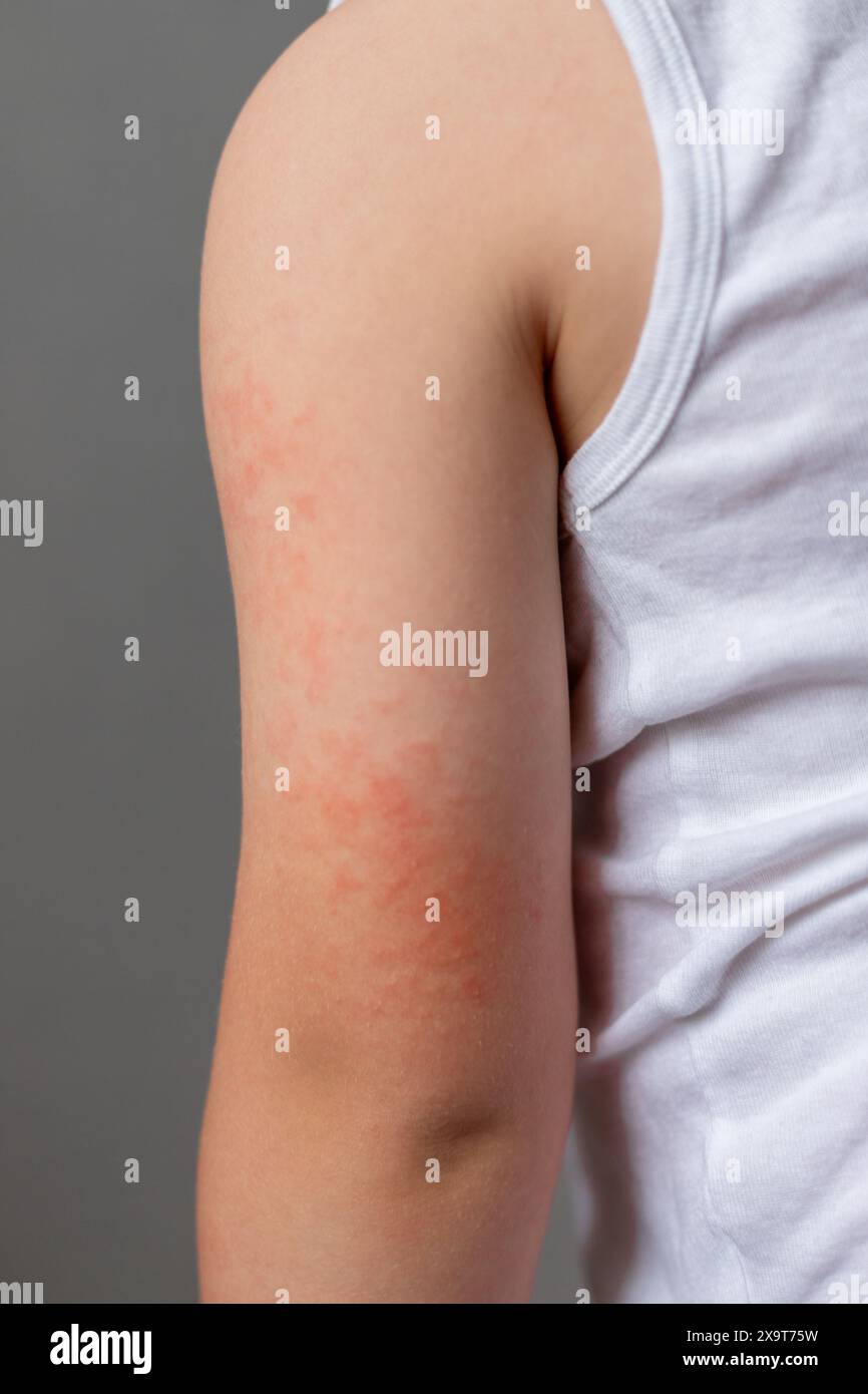 Child's arm with red rash Stock Photo - Alamy