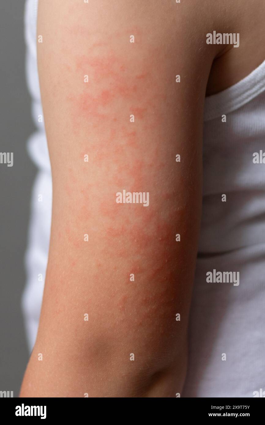 Child's arm with red rash Stock Photo - Alamy