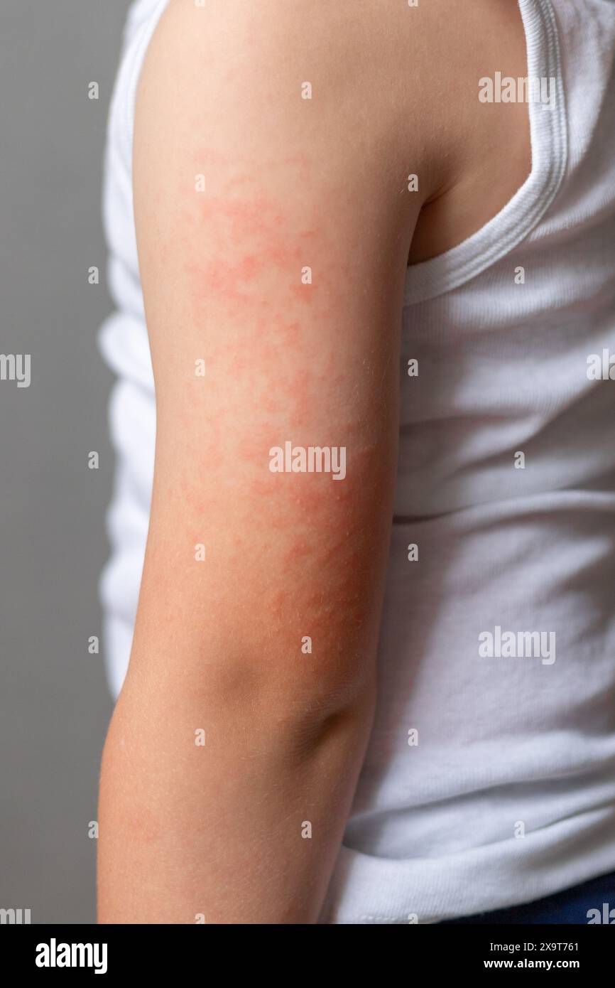 Child's arm with red rash Stock Photo - Alamy