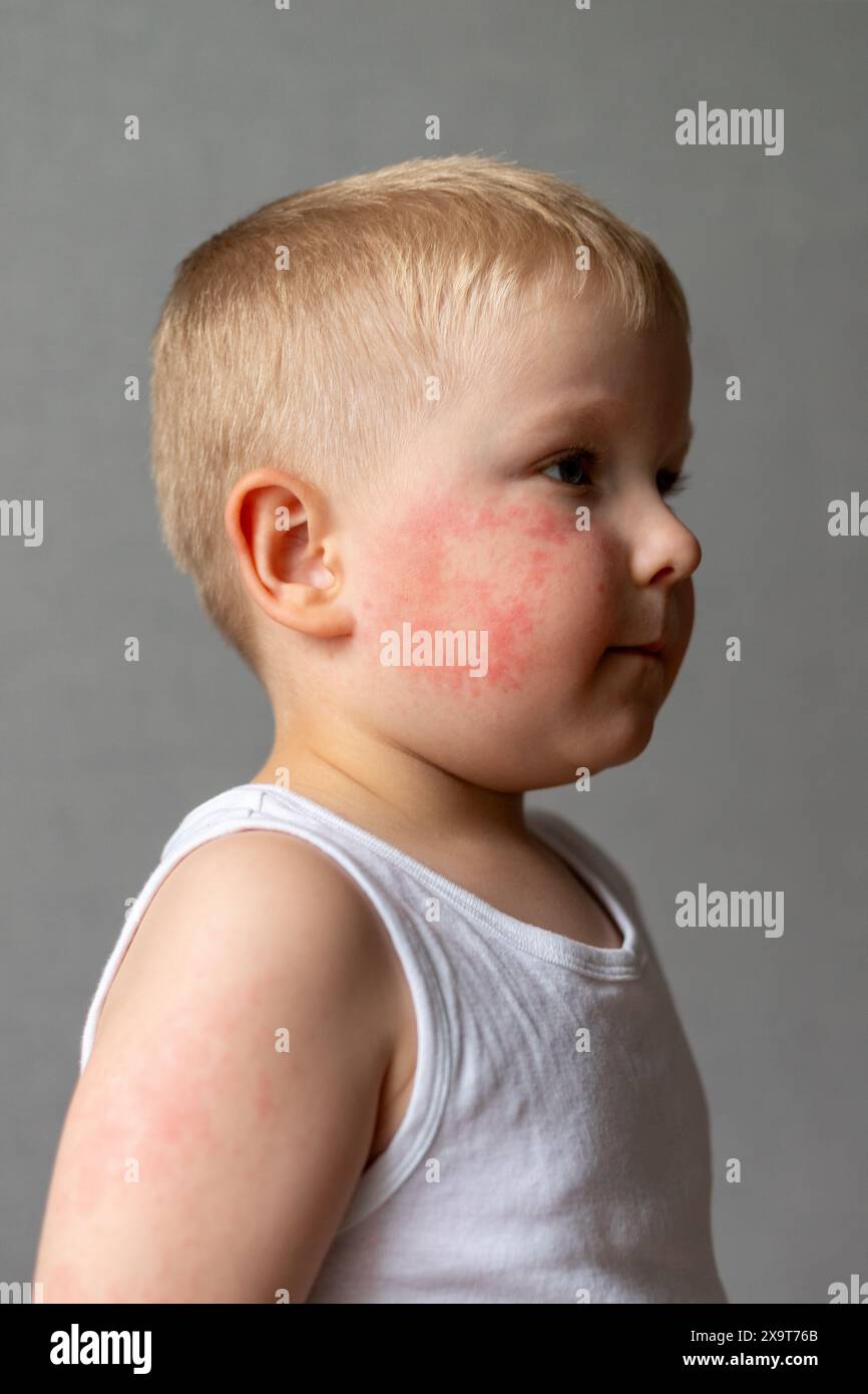 Child with rash on face and arms in white shirt Stock Photo - Alamy