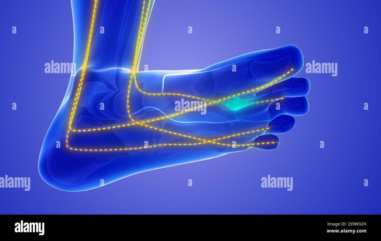 A neuroma also known as Morton's neuroma Stock Photo - Alamy