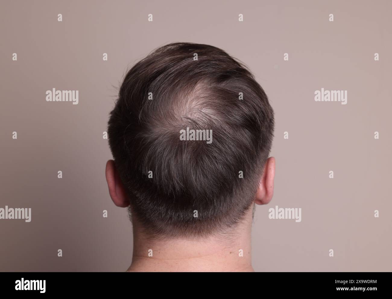 Baldness concept. Man with bald spot on beige background, back view ...