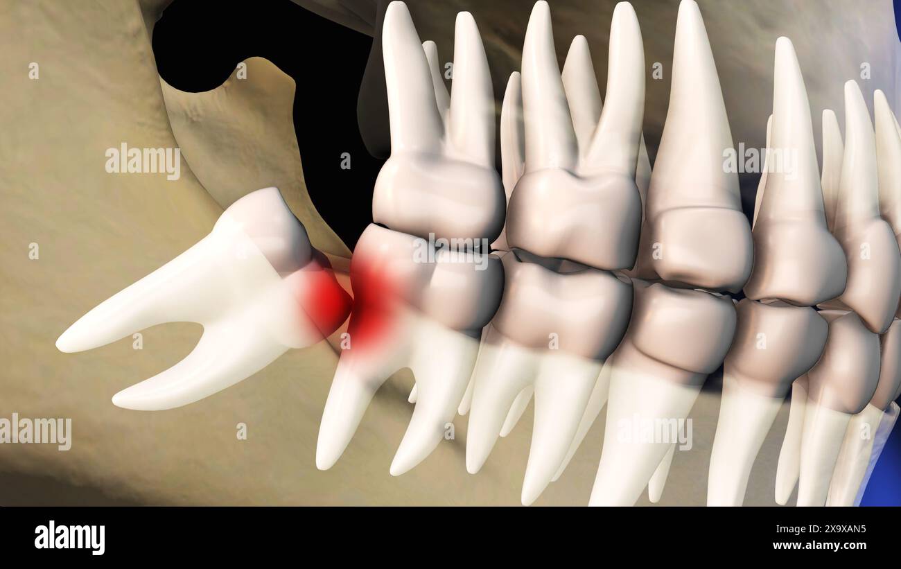 Concept of wisdom teeth pain Stock Photo - Alamy
