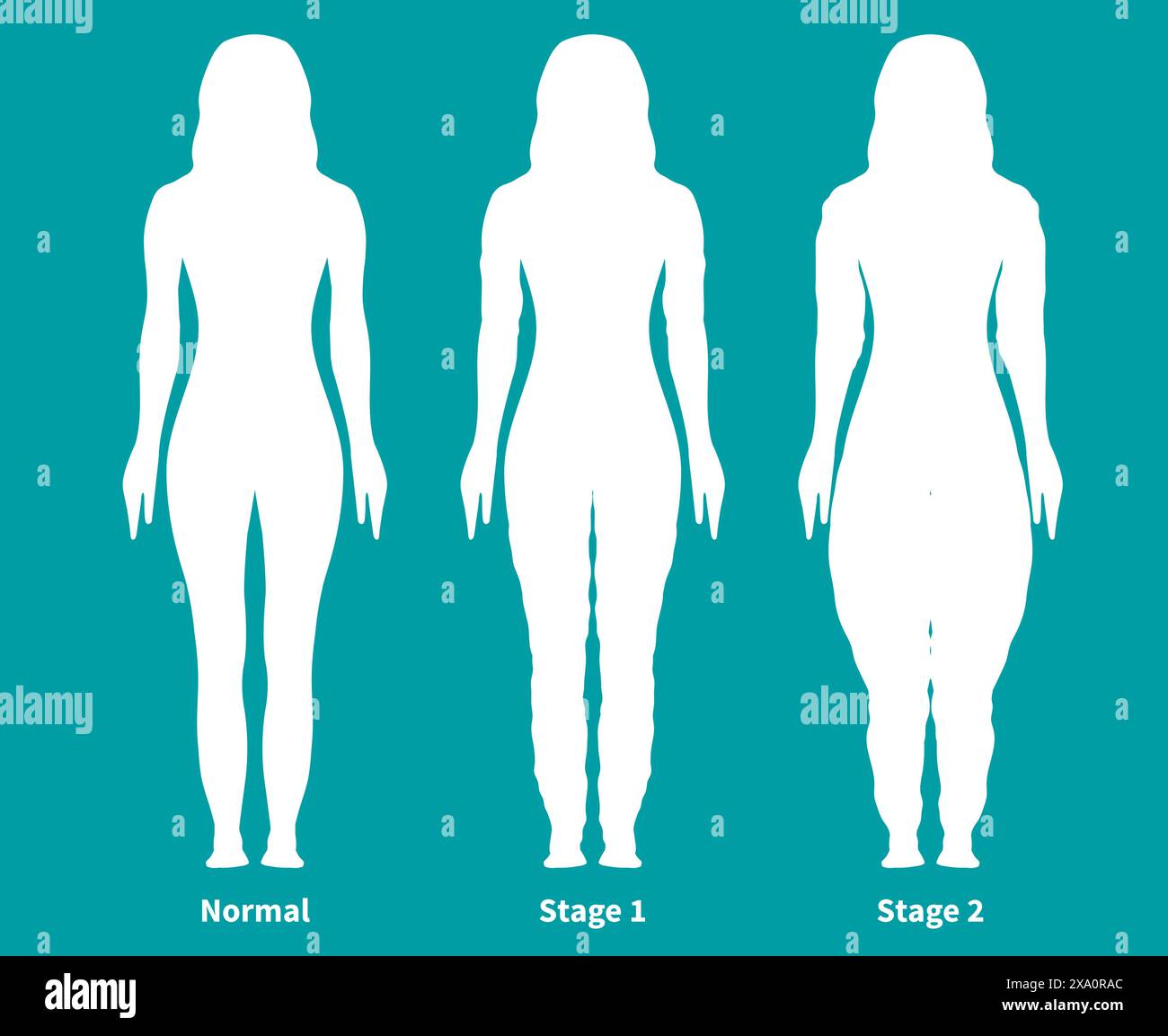 Teal Lipedema Silhouette Illustration with Woman with Normal and ...