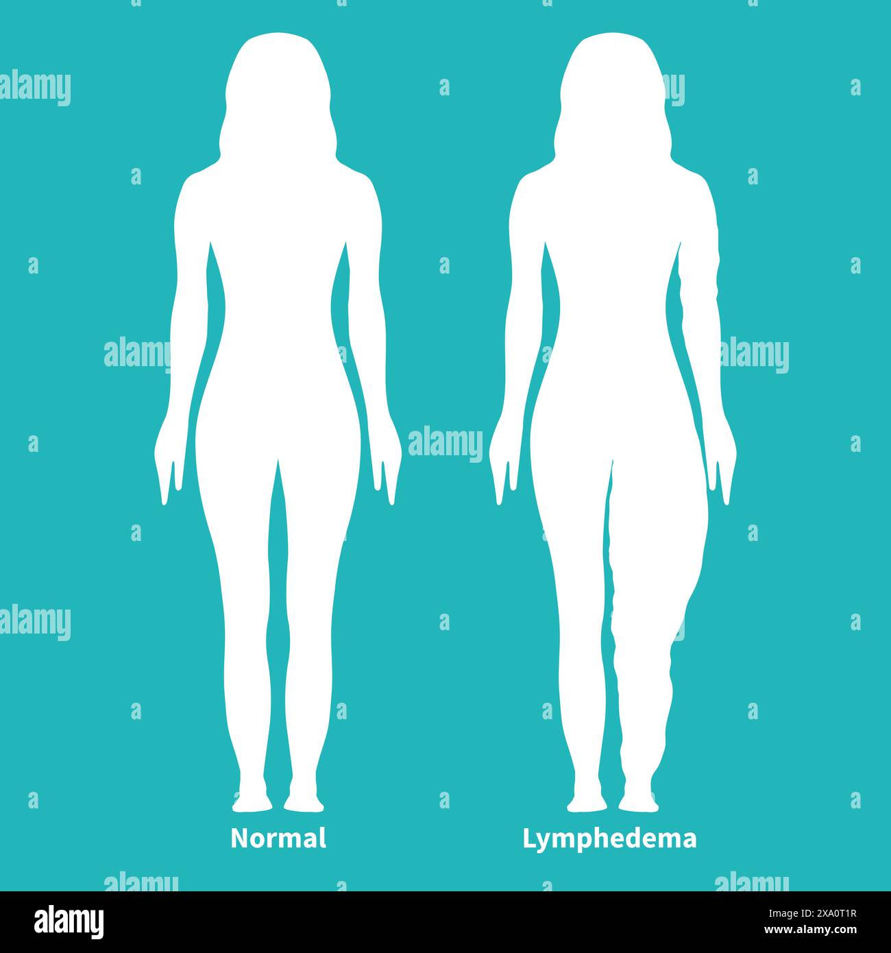 Teal Lymphedema Silhouette Illustration with Woman with Normal and ...