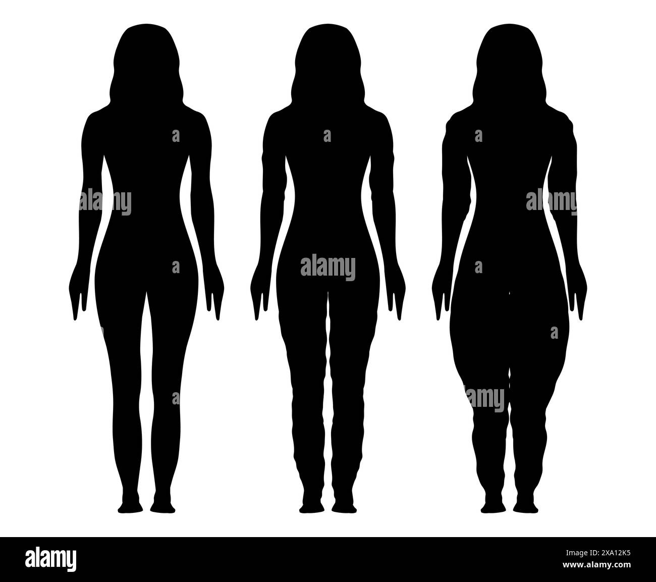 Lipedema Silhouette Illustration with Woman with Normal and Lipedema ...