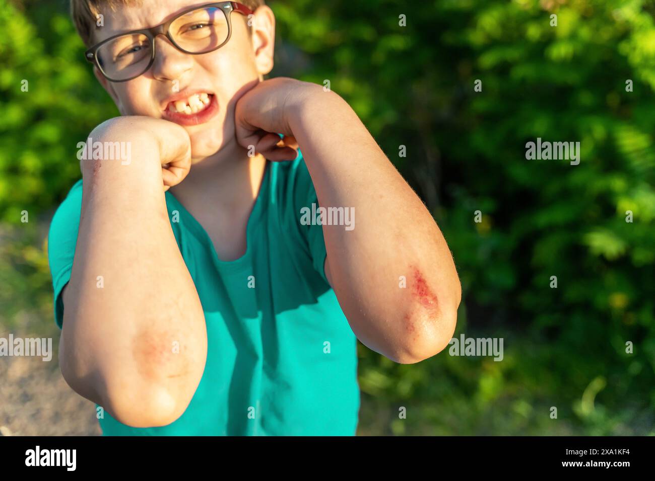 Wound blood arm child hi-res stock photography and images - Alamy