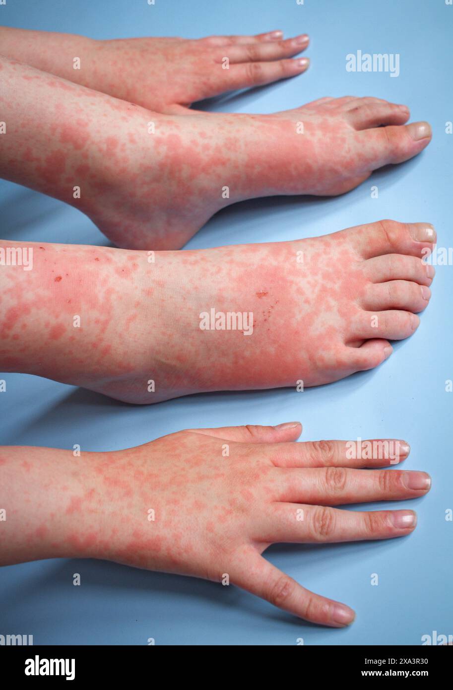 Side view of feet and hand of a teenage boy with skin rush caused by ...