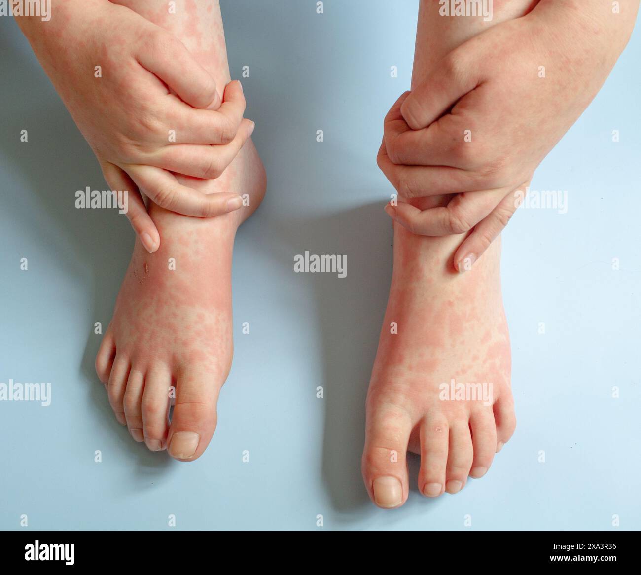 Skin rash due to allergic reaction on antibiotics, boys hands holding ...