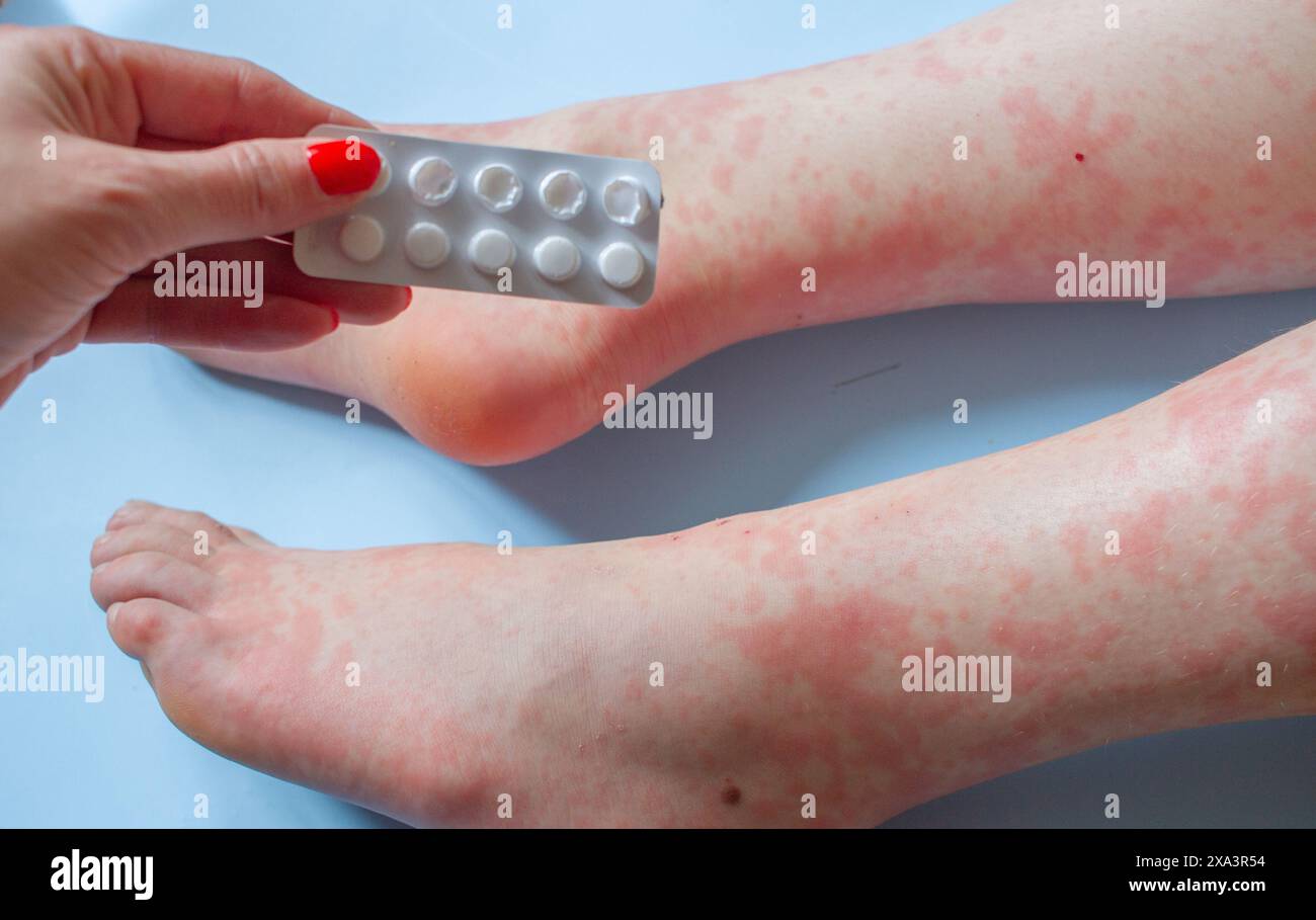 Woman hand giving a pill to a teenage boy with allergic reaction and ...