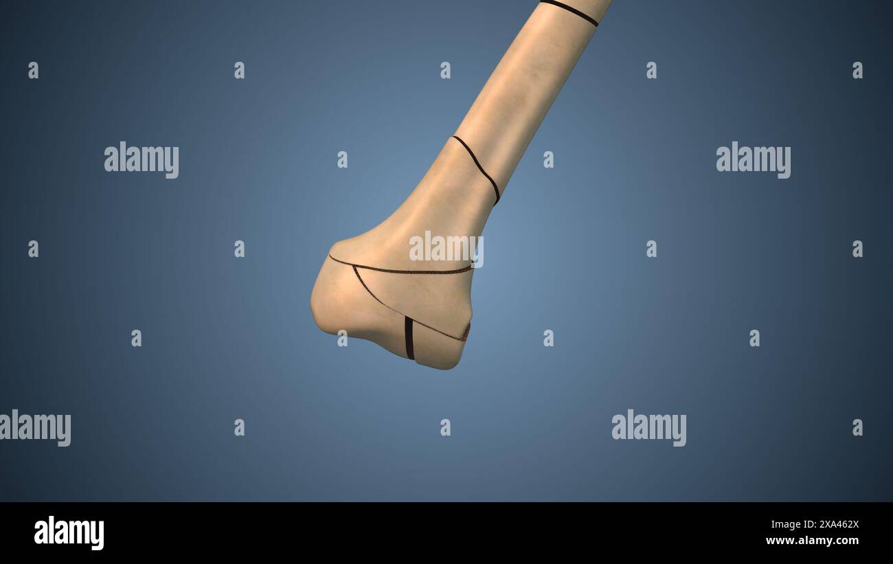 Medical Concept of Cracked Bone Or Bone Fracture Stock Photo - Alamy