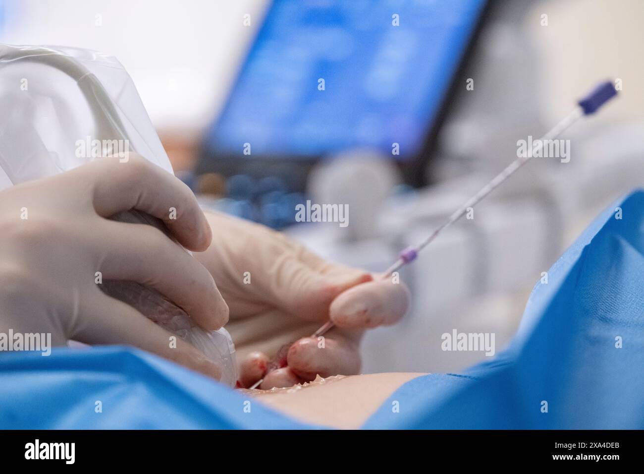 A healthcare professional wearing gloves is administering an injection, with a patient's belly ...