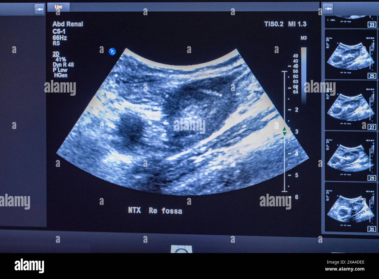 An ultrasound screen displaying medical imaging, likely from a ... An ultrasound screen displaying medical imaging, likely from a ...