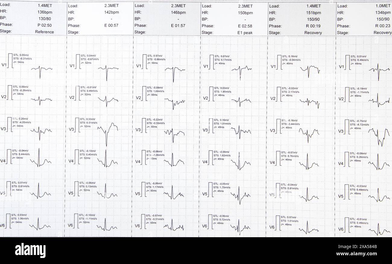 A medical ECG monitoring of a patient with heart disease Stock Photo ...