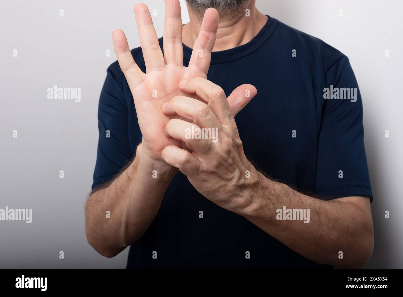 Middle aged man scratching his hand. Skin disease. Allergic reaction ...
