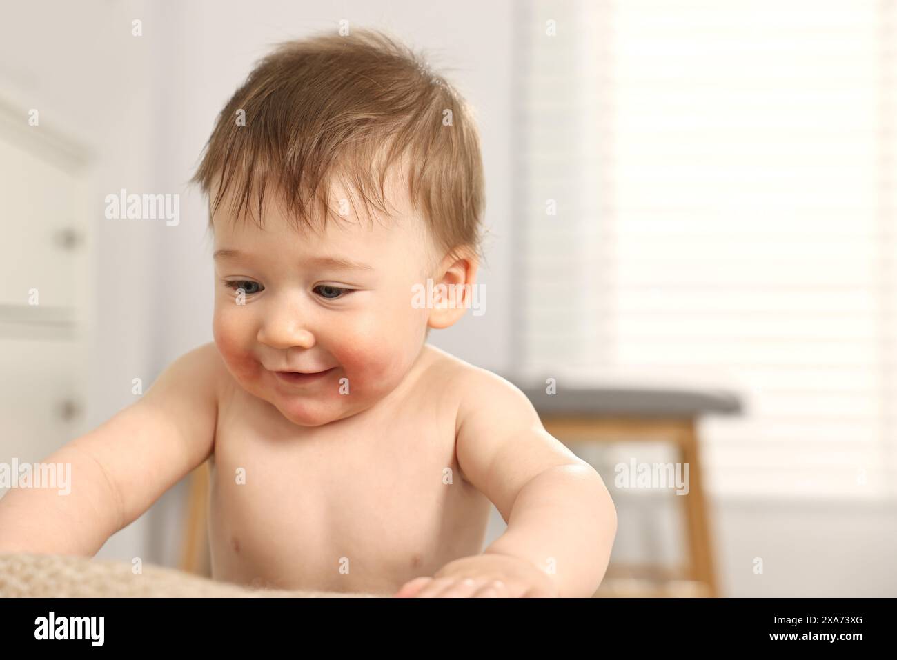 Cute little baby with allergic redness on cheeks indoors Stock Photo ...