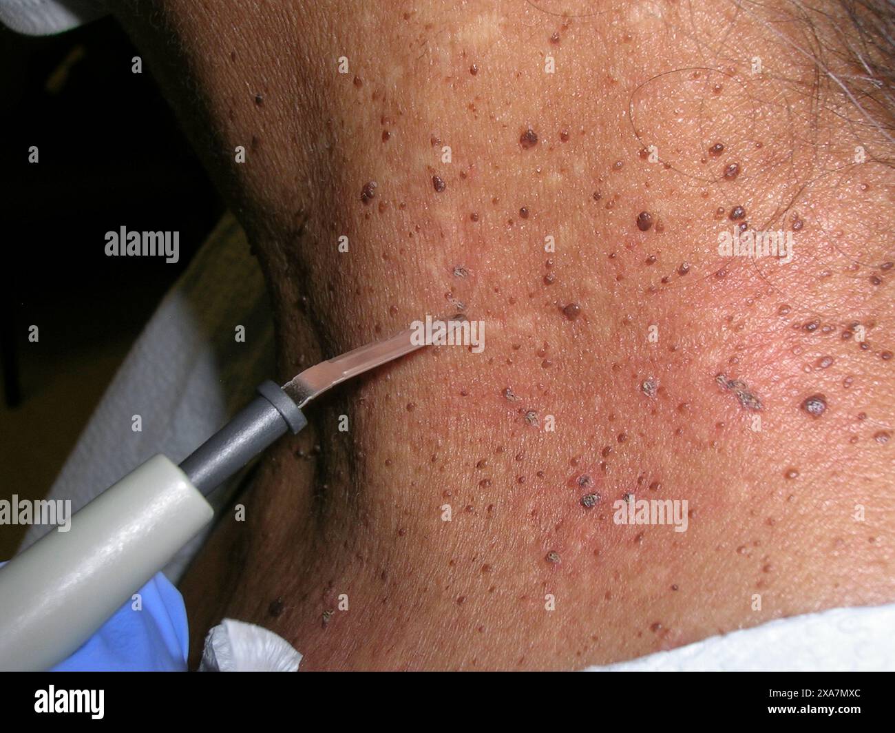 Dermatosis papulosa nigra (DPN) papules on a Hispanic woman's neck ...