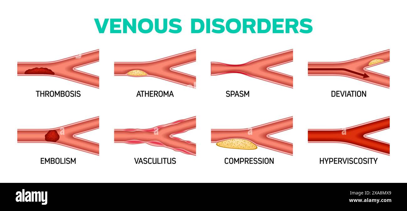 Vein disease, venous disorders vector set. Thrombosis, embolism ...