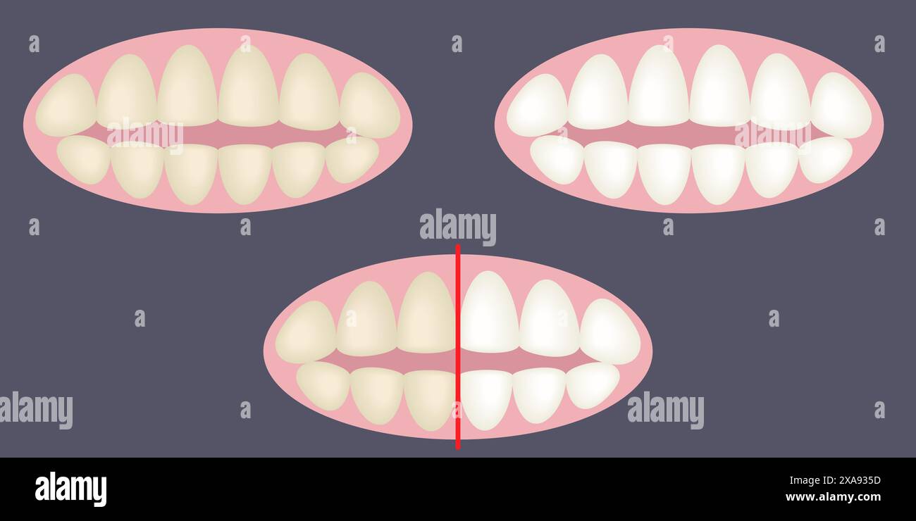 Teeth whitening. Before and after. Dental Care. Design elements. Vector ... Teeth whitening. Before and after. Dental Care. Design elements. Vector ...
