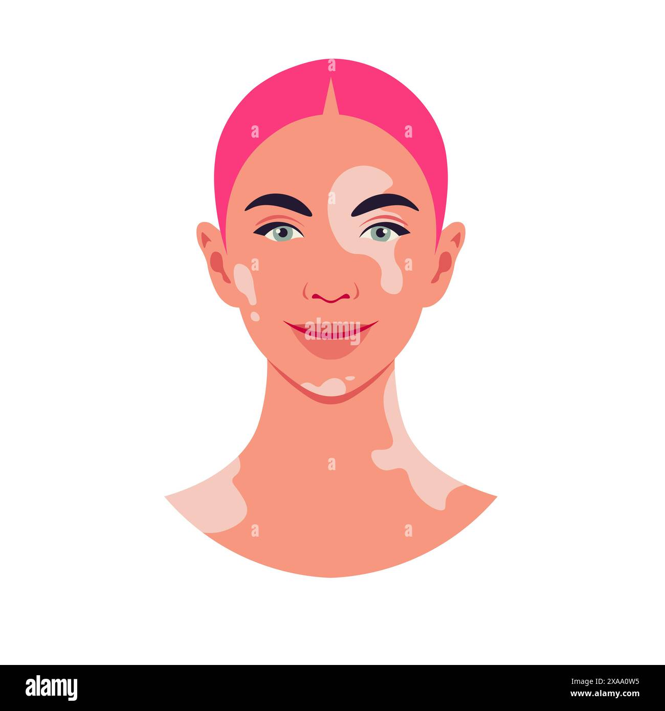 The face of a happy woman with vitiligo depigmentation on a white ...