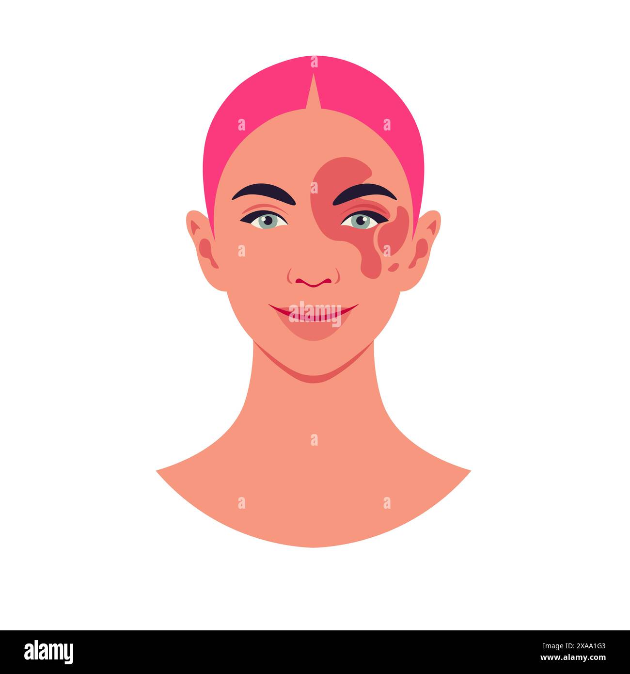 The face of a young woman with birthmark. Portrait of teen on white ...