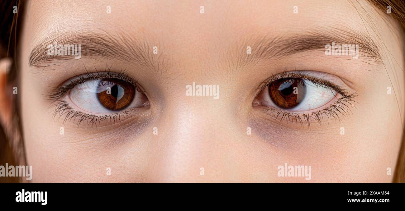 Child's face with squint. Strabismus in children causes and treatment ...