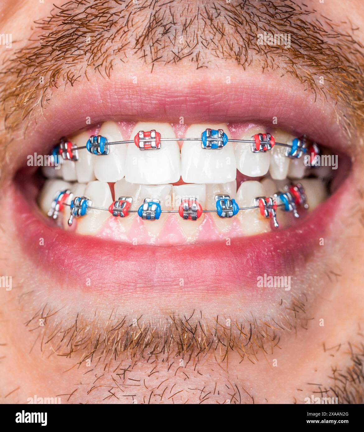 Closeup of a mans teeth with braces on. Metal braces system on the ...