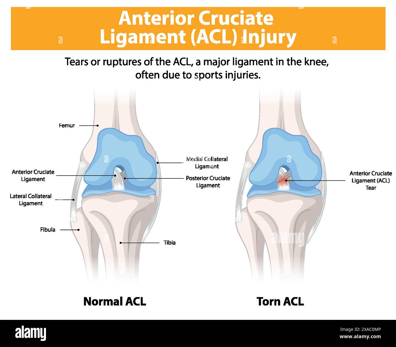 Comparison of normal and torn ACL in the knee Stock Vector Image & Art ...