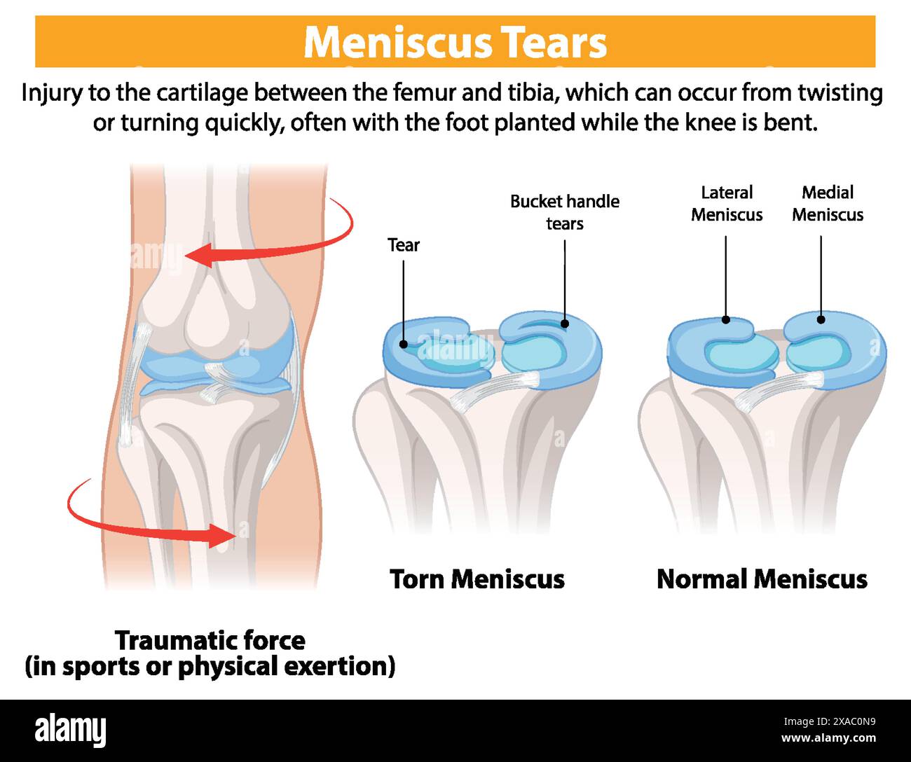 Illustration of normal and torn meniscus in knees Stock Vector Image ...