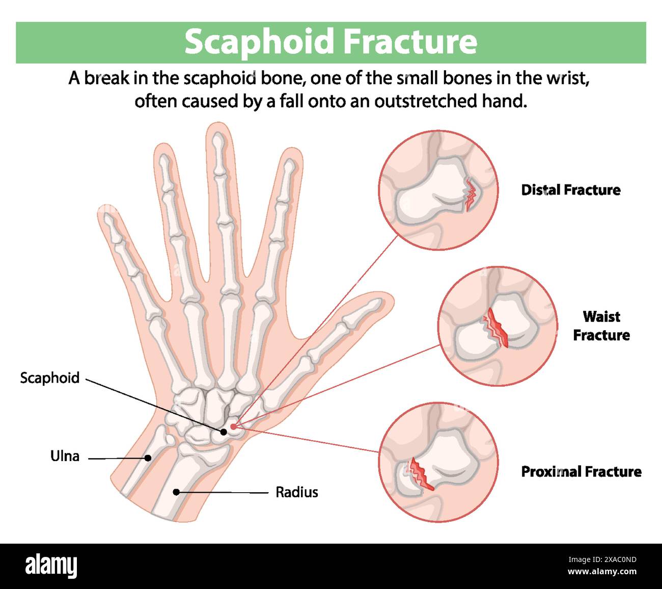 Illustration of scaphoid bone fractures in the wrist Stock Vector Image & Art - Alamy
