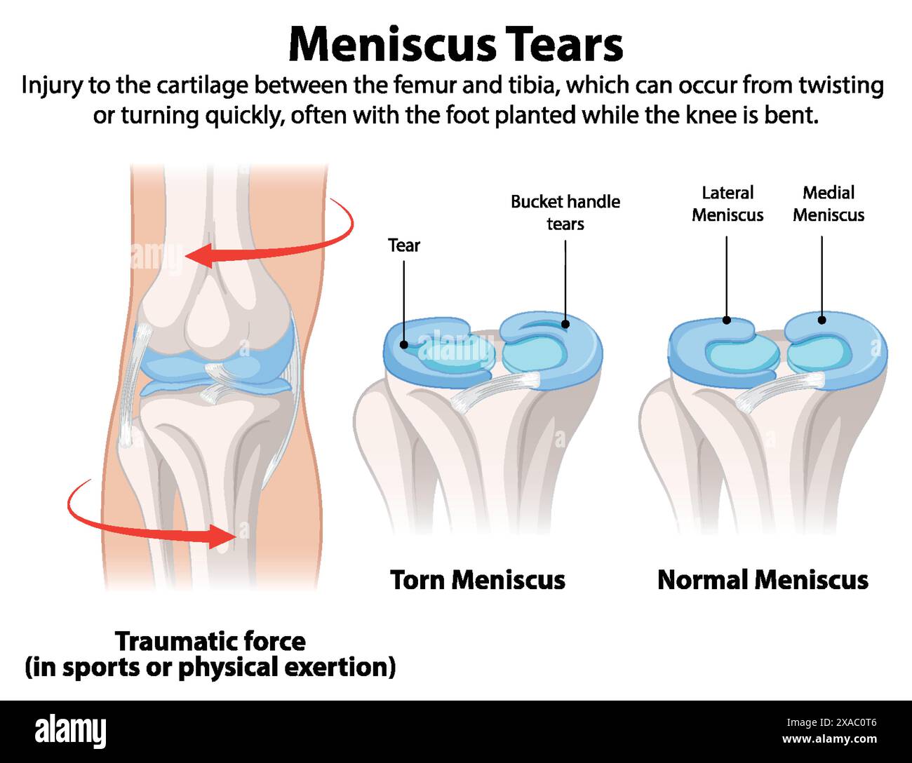 Illustration of torn and normal meniscus Stock Vector Image & Art - Alamy