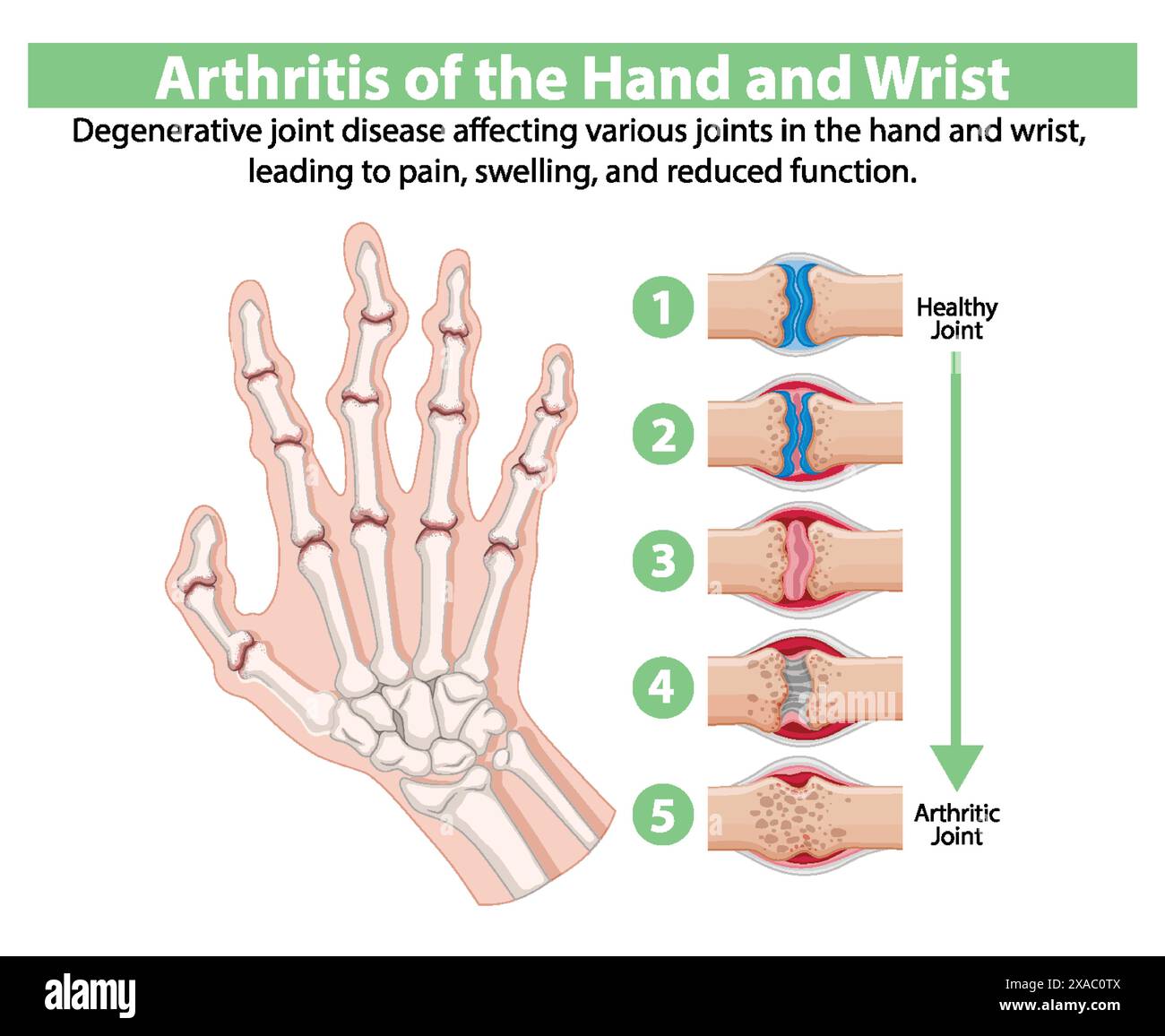 Degenerative joint disease affecting hand and wrist Stock Vector Image ...