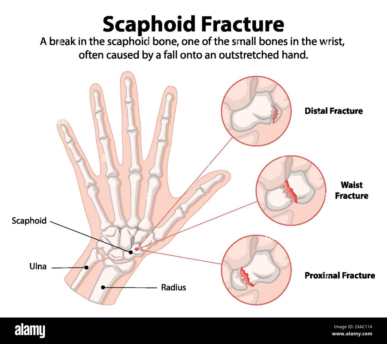 Detailed diagram of scaphoid bone fractures Stock Vector Image & Art ... Detailed diagram of scaphoid bone fractures Stock Vector Image & Art ...