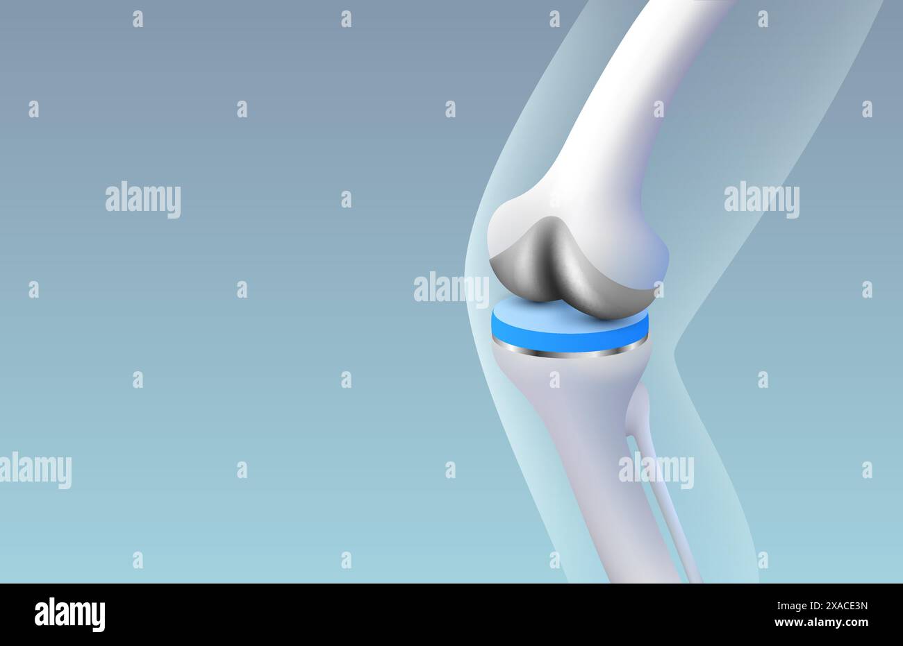 Knee implant, X-ray of the leg, 3D visualization. Vector Stock Vector ...