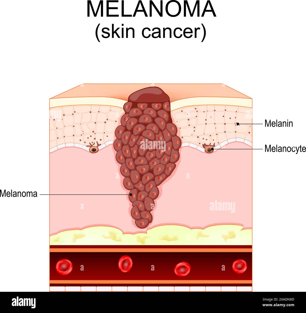 Melanoma Skin Cancer Stages