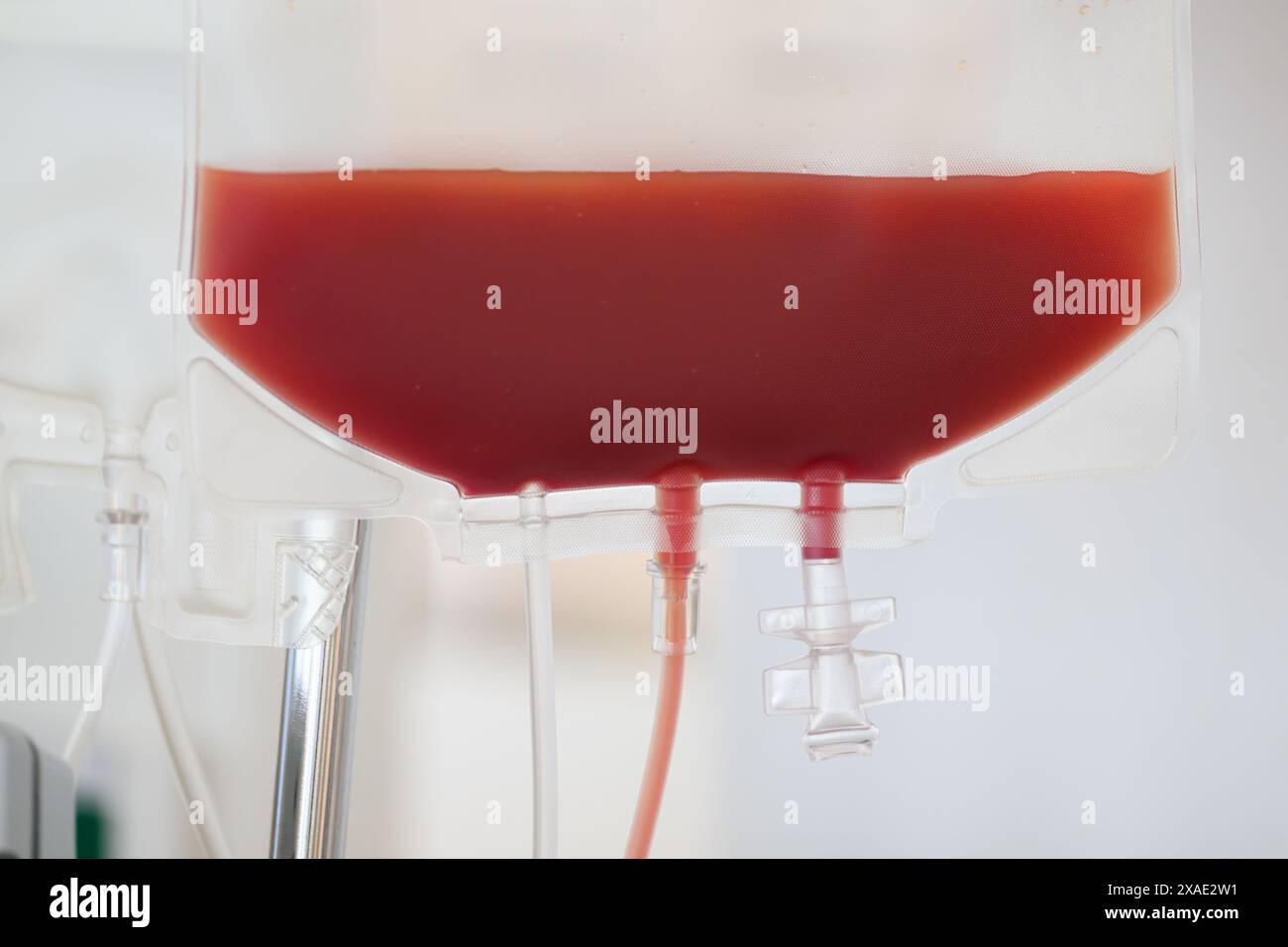 Dresden, Germany. 06th June, 2024. A transfer bag with blood stem cells ...