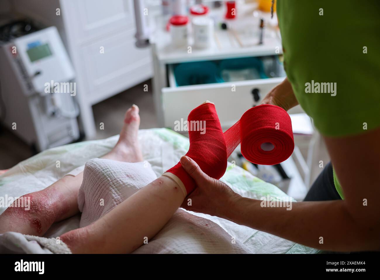 03 April 2024, Saxony, Zwickau: Käthe, who suffers from the very rare ...