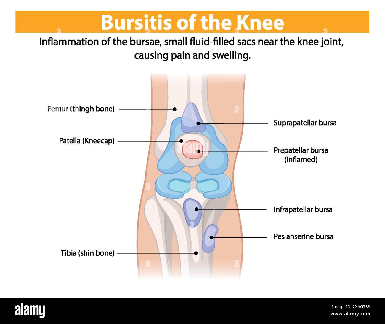 Inflammation of knee bursae causing pain and swelling Stock Vector ...
