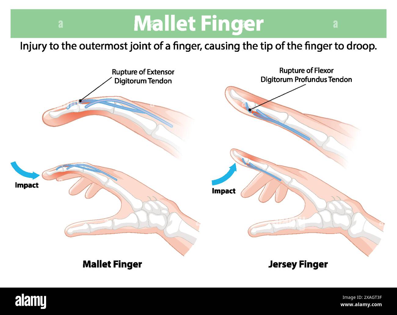 Finger tendon rupture hi-res stock photography and images - Alamy