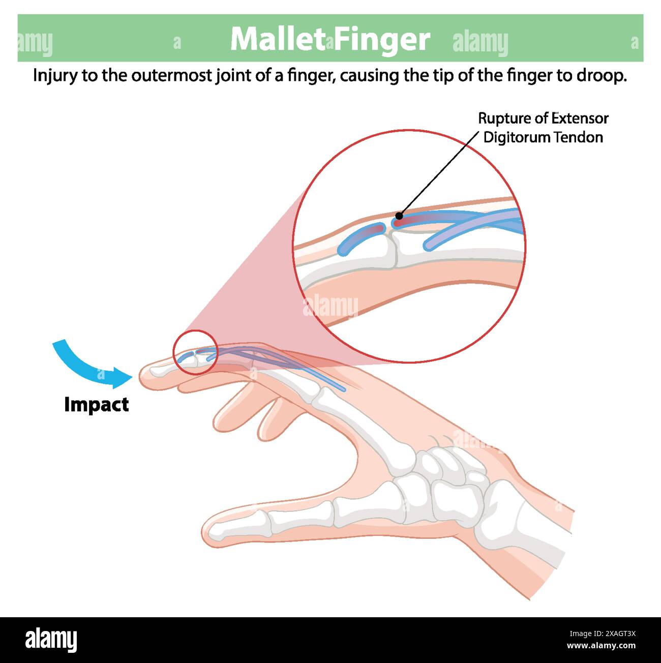 Diagram showing mallet finger injury and tendon rupture Stock Vector ...