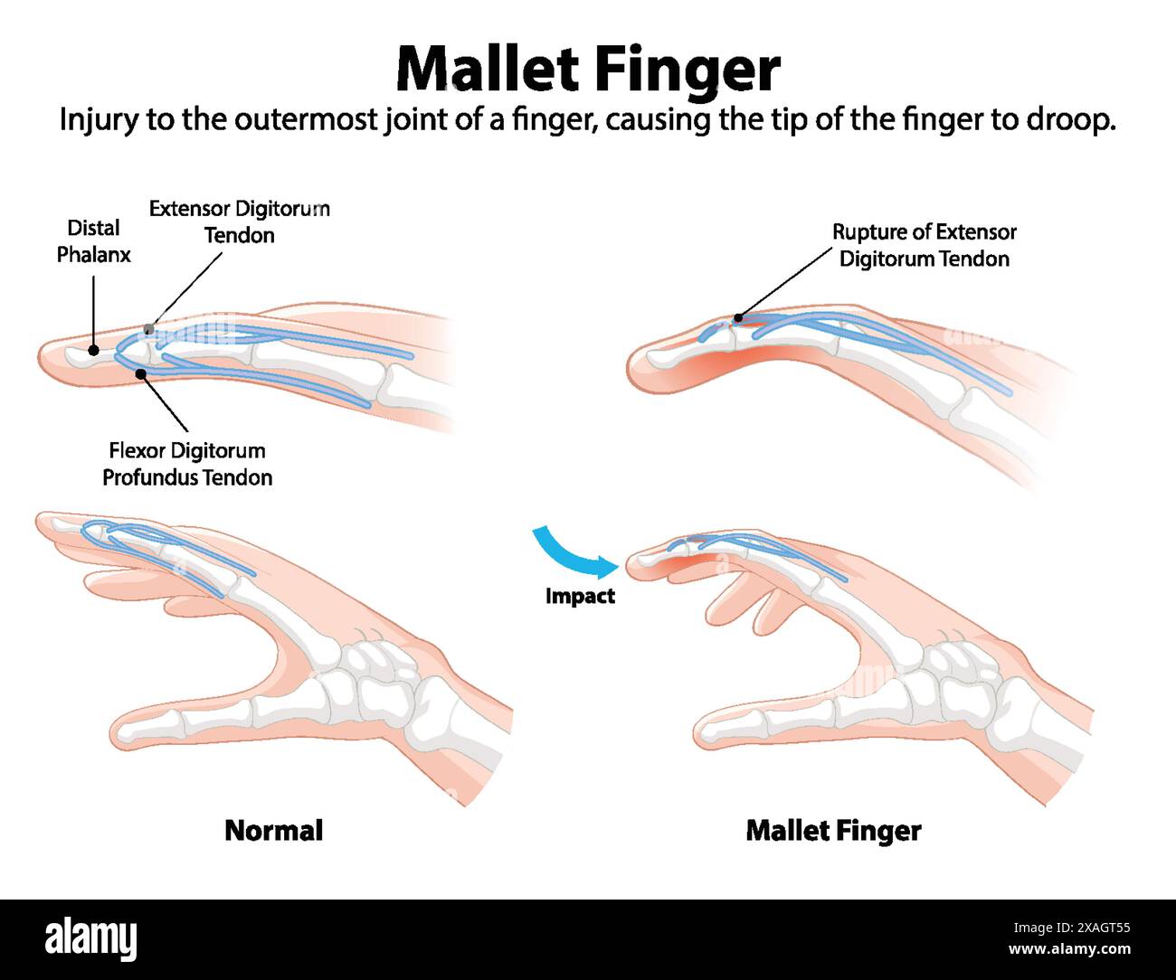 Diagram showing normal and mallet finger conditions Stock Vector Image ...