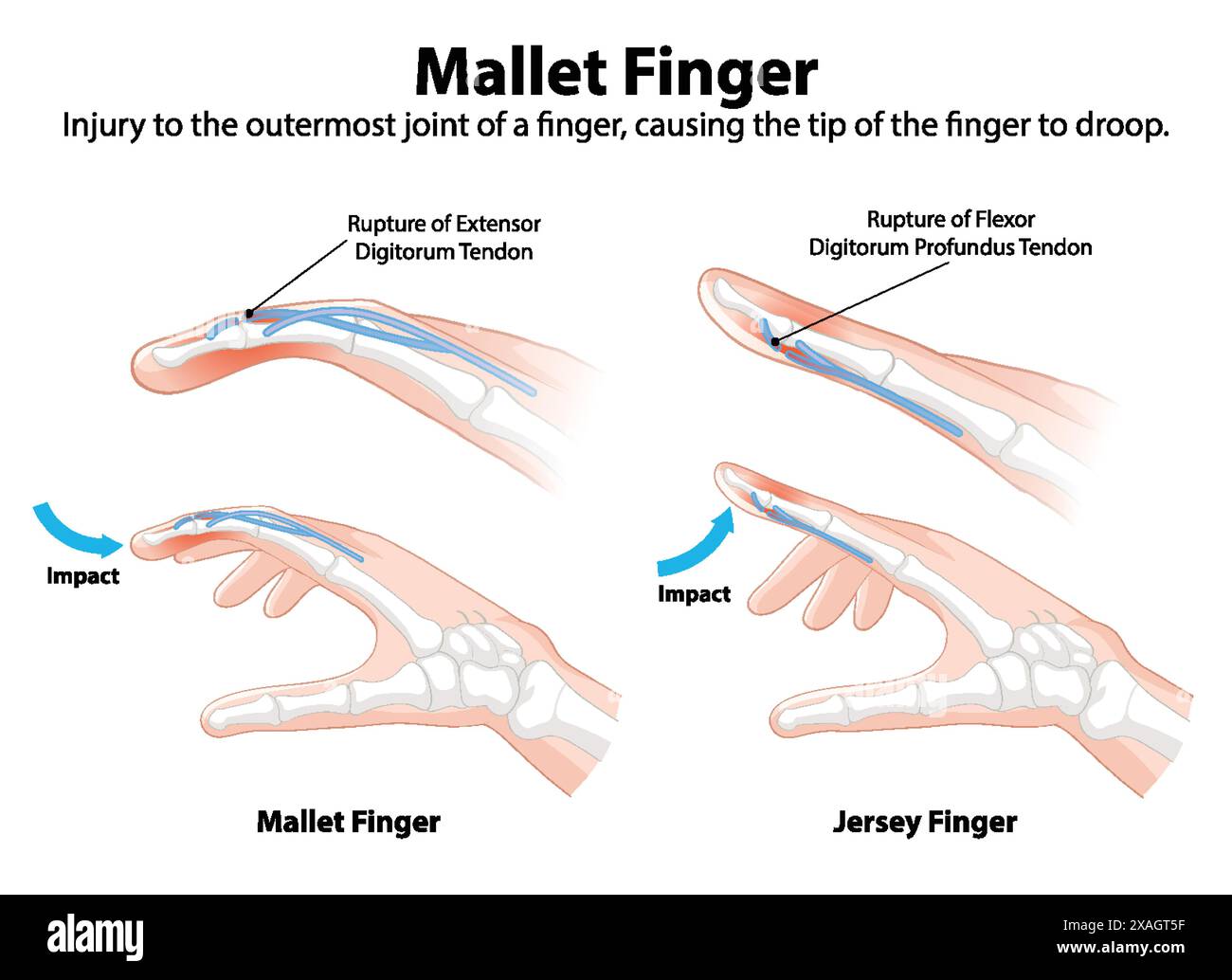 Illustration of finger tendon injuries and impacts Stock Vector Image ...