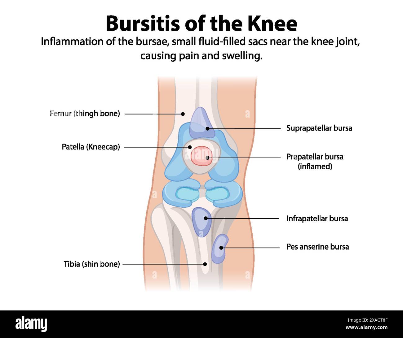 Inflammation of knee bursae causing pain and swelling Stock Vector ...