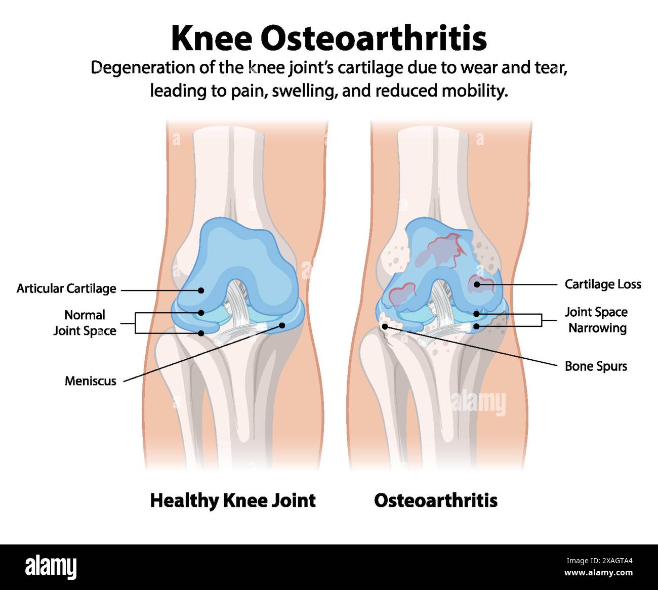 Healthy knee vs osteoarthritis-affected knee diagram Stock Vector Image & Art - Alamy