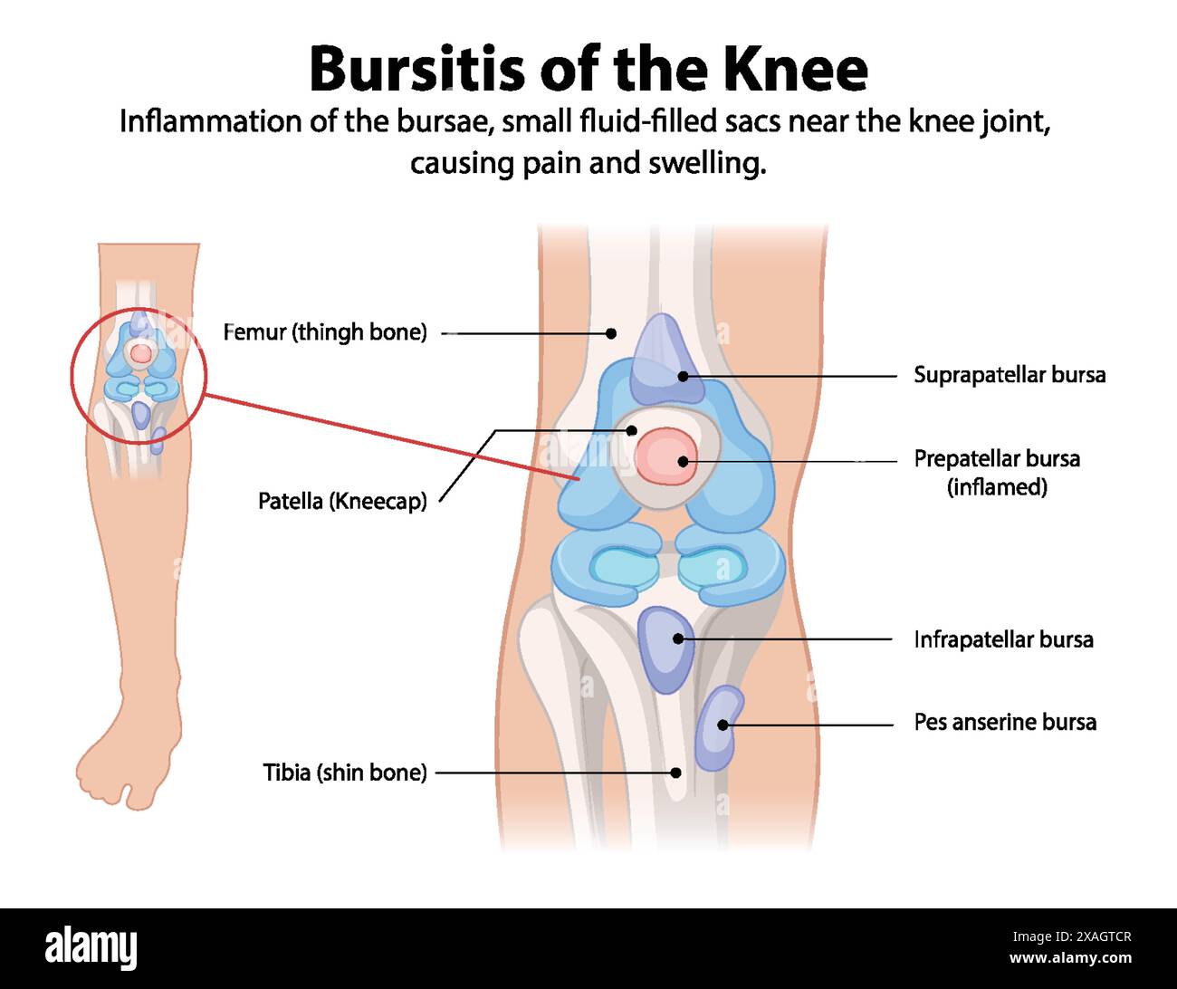 Edema In Thighs And Knees at Tamara Wilson blog