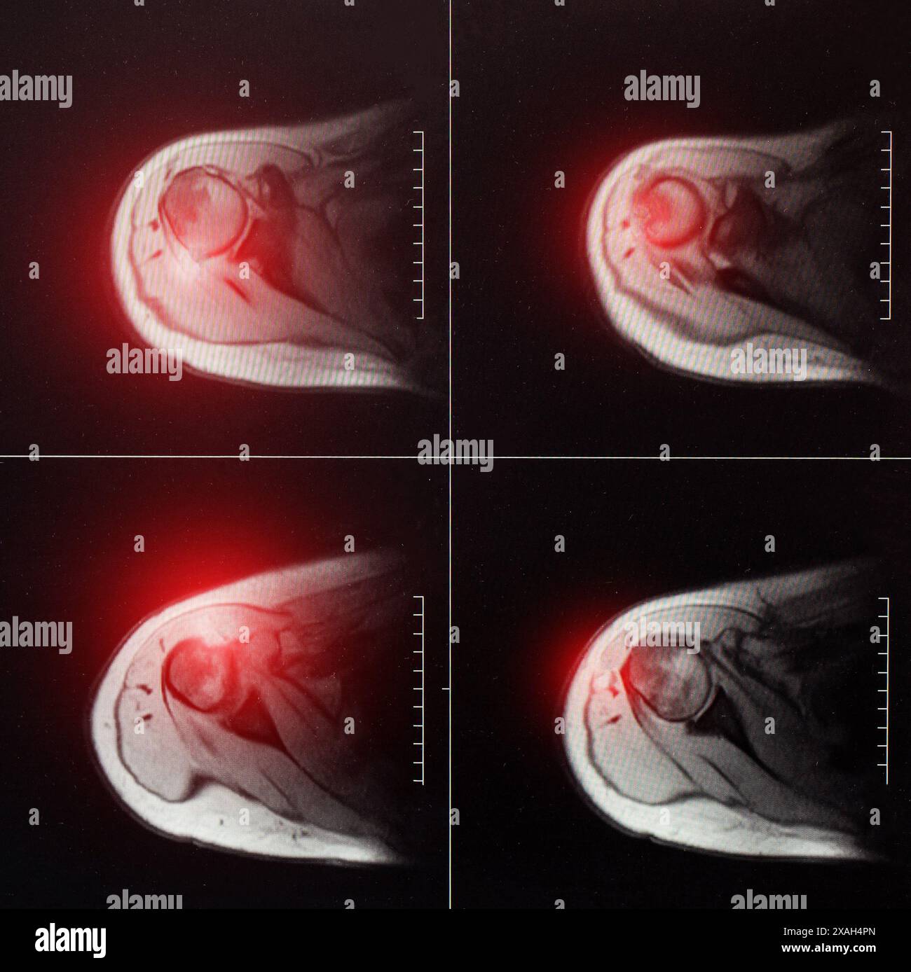 MRI image of the shoulder joint after a fracture and dislocation ...